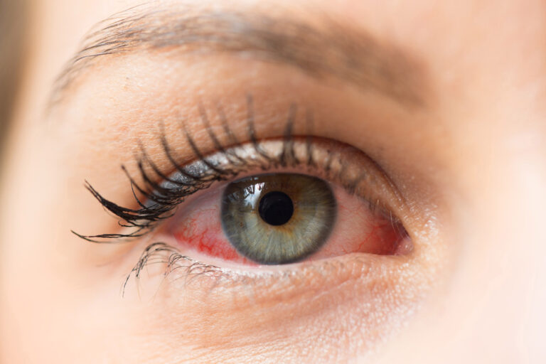 Should I See My Eye Doctor if My Eye is Red? | VisionPoint Eye Center